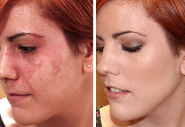 Dark Patch | Dark Patches Treatment in Delhi | Dark Patches Treatment Cost